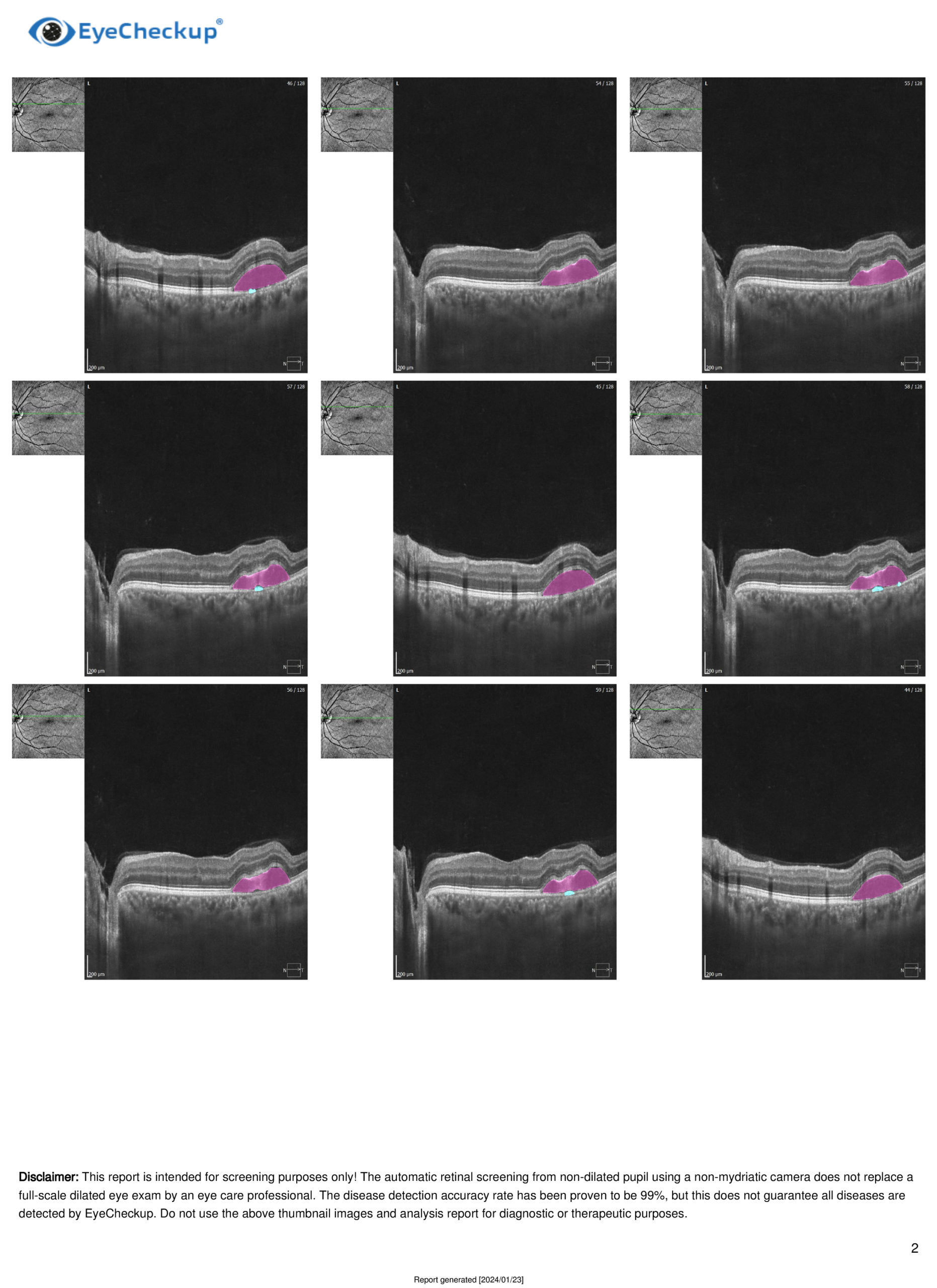 EyeCheckup – Early Diagnosis AI System